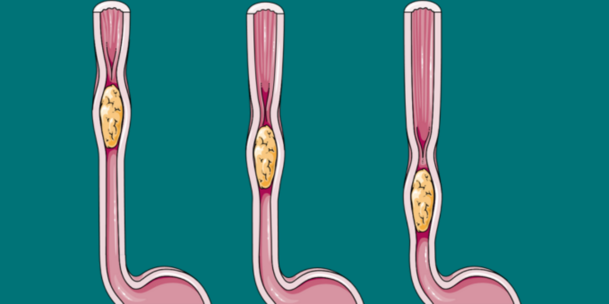 Speiseröhrenkrebs | Asklepios Klinik Altona - Asklepios Klinik Altona