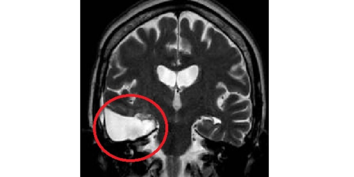 Hirntumore - Asklepios Klinik Nord Heidberg