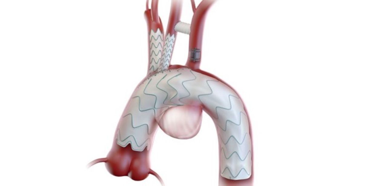 Aortenzentrum St. Georg - Asklepios Klinik St. Georg