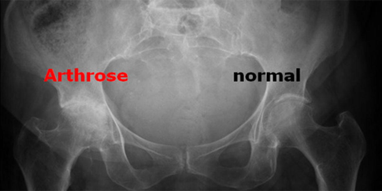 Gelenkendoprothetik - Asklepios Westklinikum Hamburg
