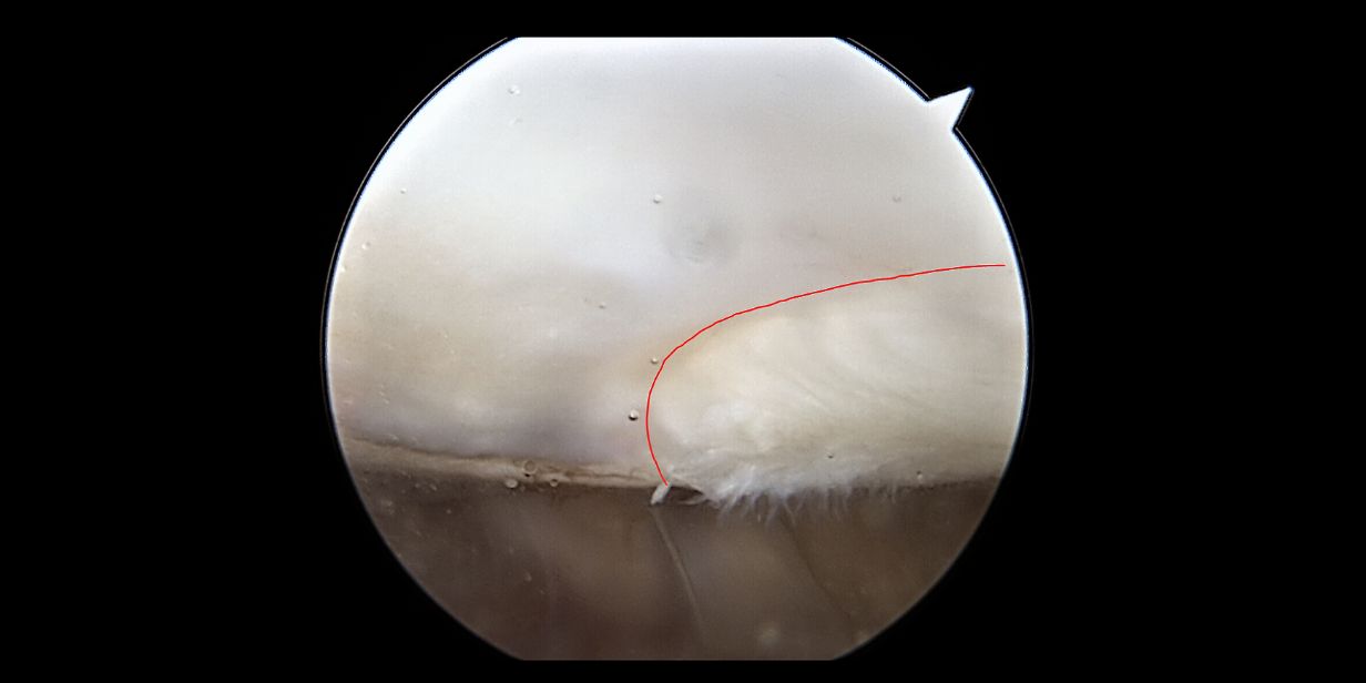 Neues Knorpeltherapieverfahren mit nur einer Operation