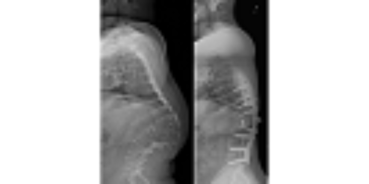 Deformitäten der Wirbelsäule - Asklepios Paulinen Klinik Wiesbaden