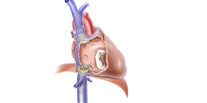 Erste TricValve-Implantation in Hamburg