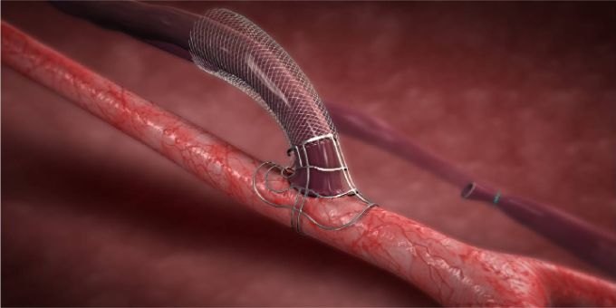 Dialysezugänge (Shunts) - Asklepios Klinik Barmbek