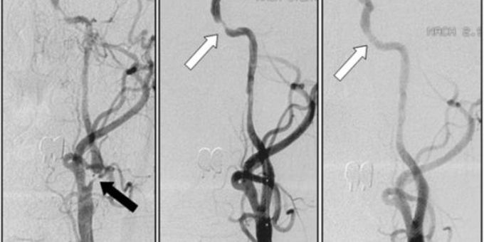 Gefäßerkrankungen des Hirns und des Rückenmarks - Asklepios Klinik Nord ...