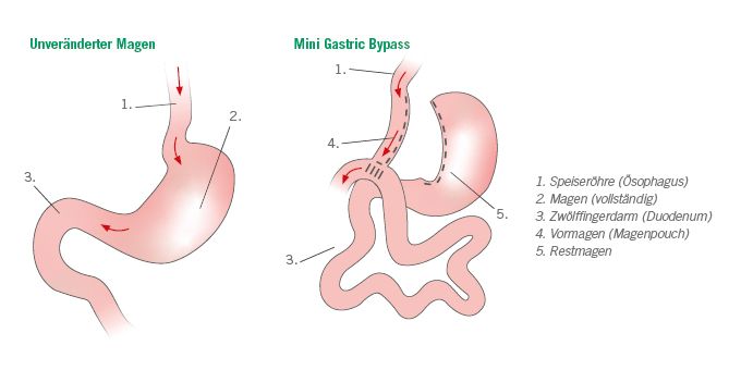 Adipositaszentrum - Asklepios Westklinikum Hamburg