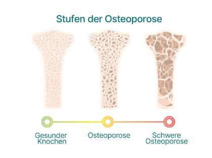 Wunderschne Vorstufe Der Osteoporose Bild