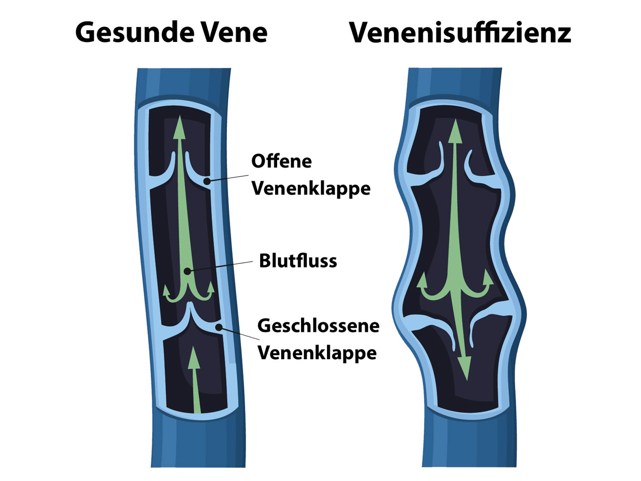 Venenschwäche - Wenn die Beine schwer werden - Asklepios Gesundheitsmagazin